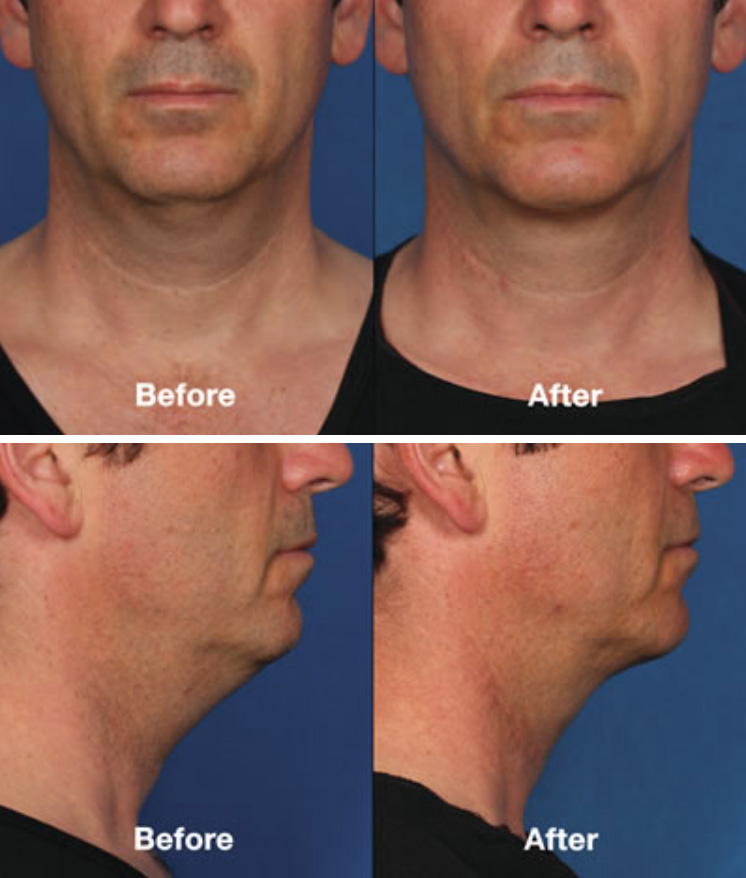 Kybella: the injectable, non-invasive double chin treatment - Precision ...
