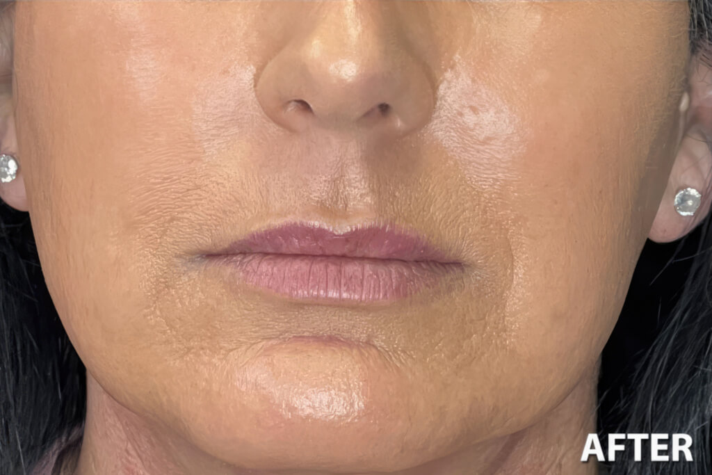 Lip Fillers Before & After - Precision Aesthetics Medical Group ...