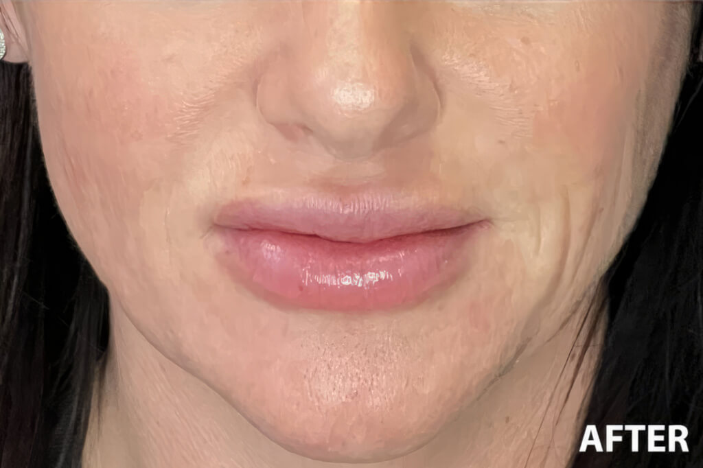Lip Fillers Before & After - Precision Aesthetics Medical Group ...