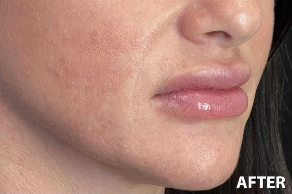 Lip Fillers Before & After - Precision Aesthetics Medical Group ...