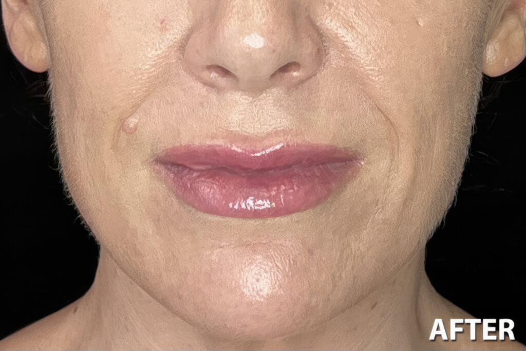 Lip Fillers Before & After - Precision Aesthetics Medical Group ...