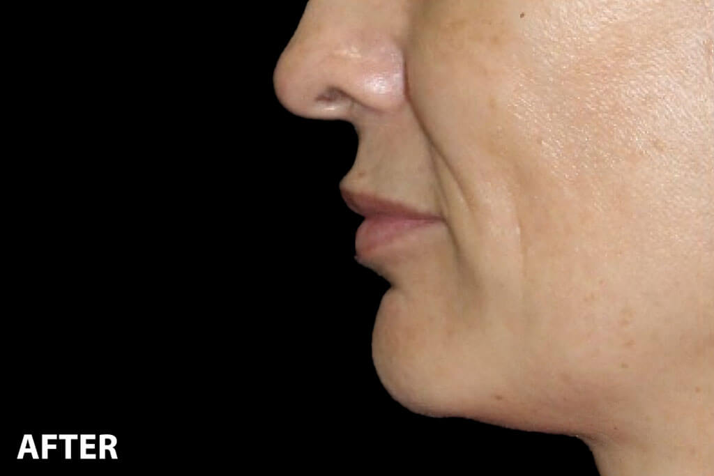 Chin Augmentation Before & After - Precision Aesthetics Medical Group ...